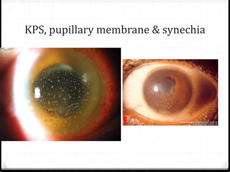 Red Eye With Differentials And Sample Causes PPT