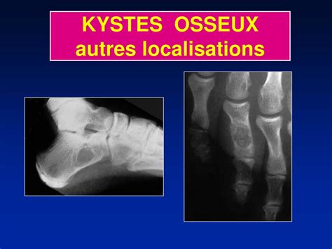 Ppt Kyste Osseux Kyste Solitaire Powerpoint Presentation Free Download Id 507080