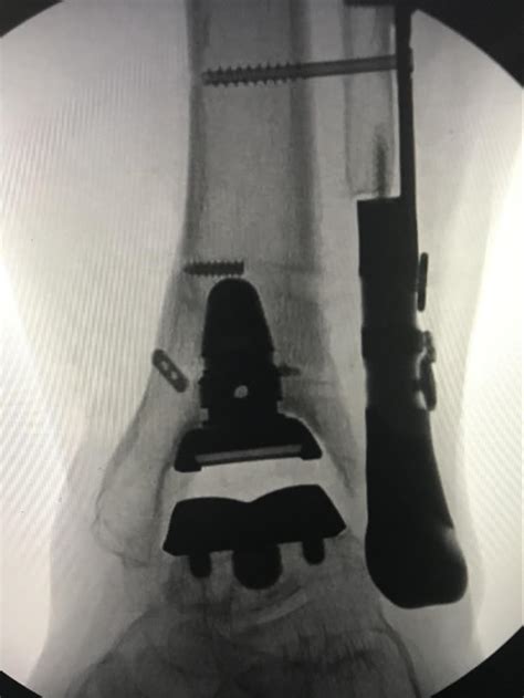 Fibular Resection The Foot And Ankle Online Journal