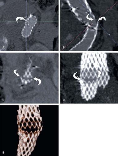 Postprocessing And Data Analysis Thoracic Key