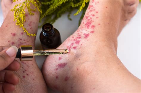 오일과 약초로 전염성 발 질환의 치료 발 곰팡이와 알레르기 성 발진 건선에 대한 스톡 사진 및 기타 이미지 건선 다리 신체 부분 건강관리와 의술 Istock