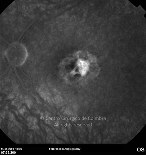 Caso Clínico 1 Atlas Rl Eye