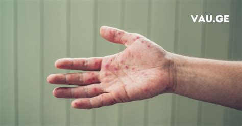 Როგორ დავიცვათ თავი კოკსაკის ვირუსისგან პრევენციული მეთოდები Vap Ge