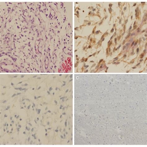 Partially Resected Optic Pathway Glioma Opg From Patient 4 Download Scientific Diagram