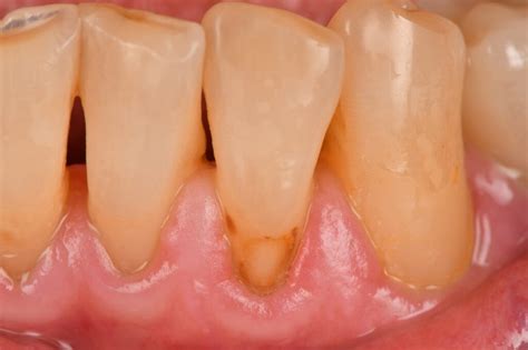 Class V Composite Restorations To Restore Form