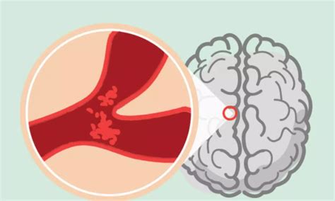 Brain Stimulation Promising Treatment For Patients With Acute Ischemic
