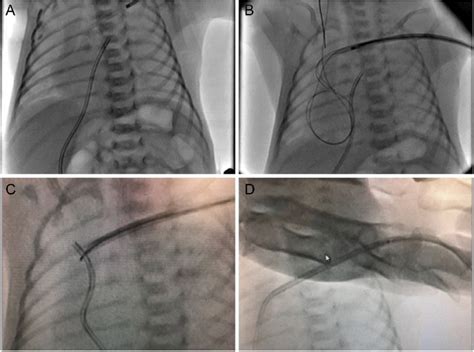 A Angiographic Images Of An Embolized Catheter In RA PFO PV B In