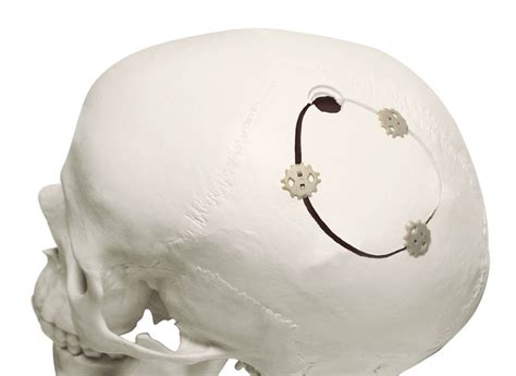 Titanium Plates And Screws Craniotomy At Cristina Lee Blog