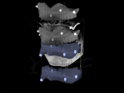 Subperiosteal Customized Implant On Atrophic Maxilla Bandb Dental