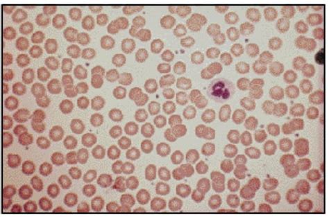 Frotis Sanguíneo Del Perro ¿qué Alteraciones Podemos Encontrar Cuas