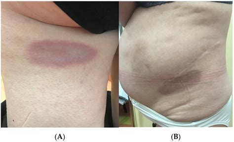 Generalized Morphea A Rare Variant Of Localized Morphea Localized