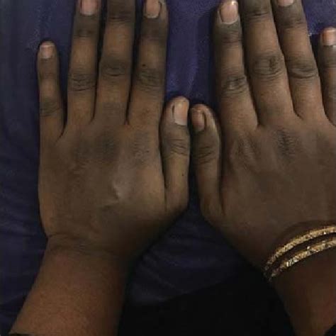 Patchy Pigmentation Of The Tongue Download Scientific Diagram