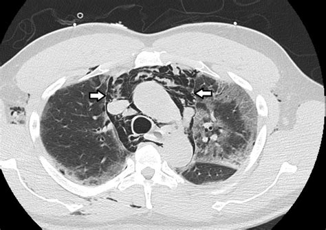 Spontaneous Pneumomediastinum In Covid 19 Bmj Case Reports