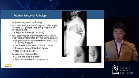Adult Spinal Deformity Surgery Complication Prevention Kee D Kim MD YouTube