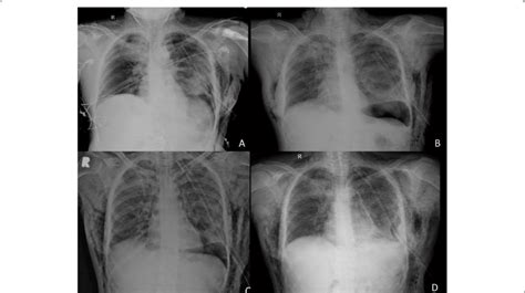 Posteroanterior Radiographs On A Day 4 Post Surgery B Day 6