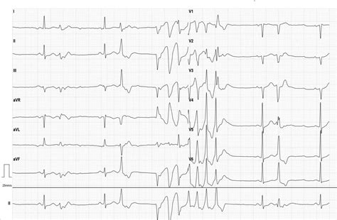 Polymorphic Ventricular Tachycardia During A Stress Ekg What Is The