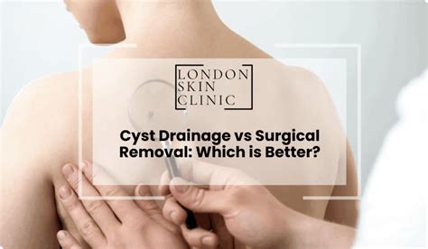Cyst Removal Aftercare Preventing Infection