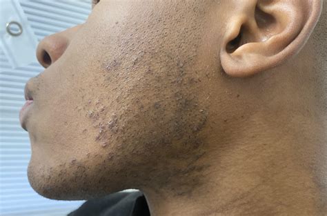 What Is Hyperpigmentation And How Can You Cure It Aaron Wallace