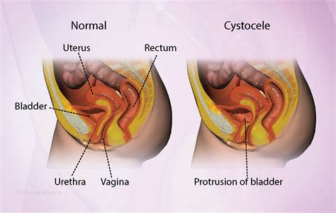 Cystocele Grading