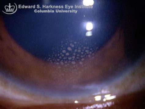 Mutton Fat Keratic Precipitates Vagelos College Of Physicians And