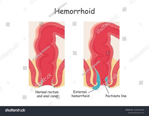 Hemorrhoids Rectum Vector Illustration Cartoon Style Stock Vector