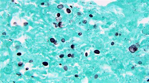 Cryptococcus Histology