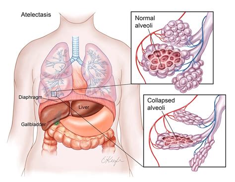 Atelectasis Alveoli Collapse