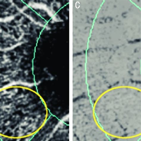 En Face Oct Angiography Of The Onh Segmentation A The Rpc