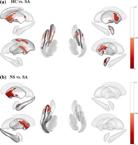 Comparison Of Subcortical Local Shape Volumes Between Groups A Shape