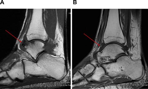 Ankle Arthrofibrosis