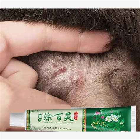 Head Folliculitis Scalp Pustules Pimples Itchy Scalp Dandruff Acne Folliculitis
