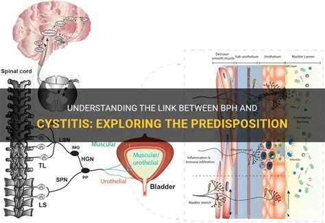 Understanding The Link Between Bph And Cystitis Exploring The