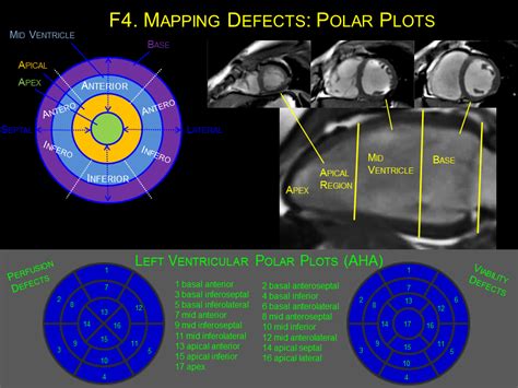 Myocardial Perfusion Cardiac Mri