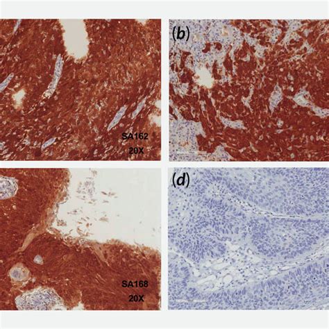 Expression Of P16 Ink4a In Hpv73 Positive Cervix Cancer Specimens