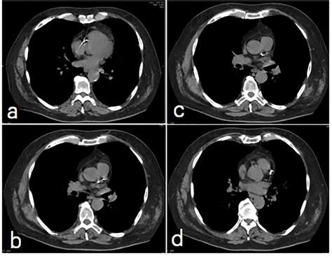 A Non Contrast Non Gated Chest Ct Image Series For Cac A Rca Download Scientific Diagram