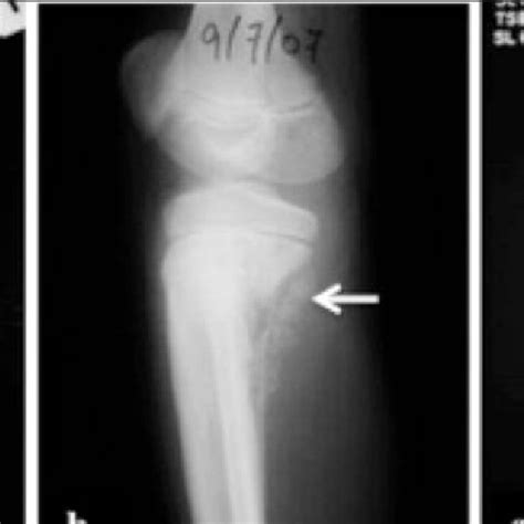 Case Anteroposterior A And Lateral B Plain Radiographs Of The Download Scientific