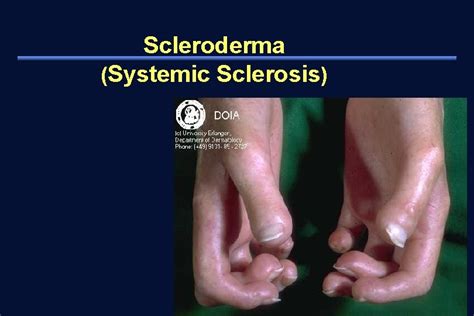 Scleroderma Systemic Sclerosis Definition Systemic Sclerosis Scleroderma A