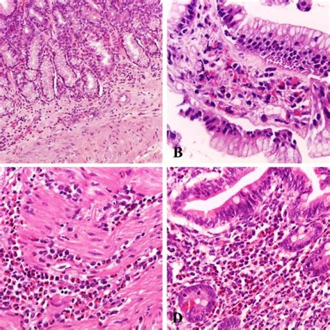 A Food Protein Induced Allergic Proctocolitis Presence Of Lymphoid