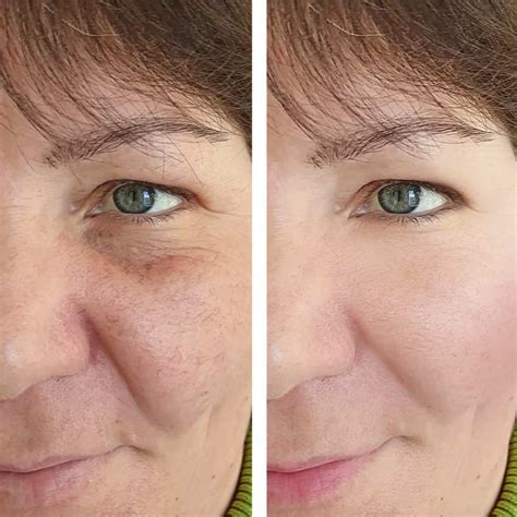 The Best Before And After Hifu Results