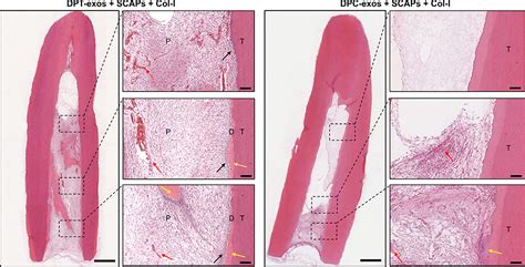 Pulp Tissue Derived Exosomes In Pulp Regeneration Ijn