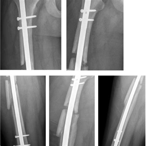 Pdf Management Of Twenty Centimeter Segmental Bone Defect Of Femoral