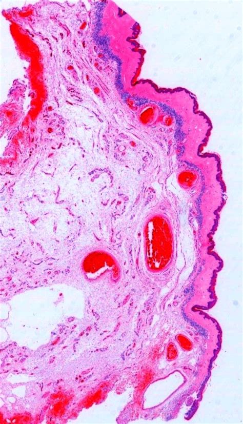 Balanitis Xerotica Obliterans Histology