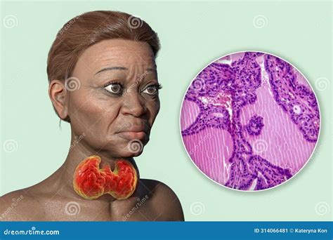 Toxic Goiter 3d Illustration And Micrograph 302528511