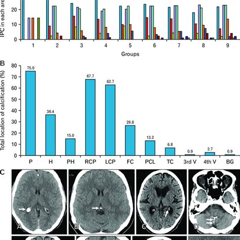 A Estimated Volume Of Pineal Gland Calcification B Estimated
