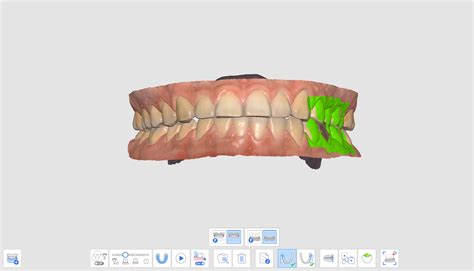 Occlusion