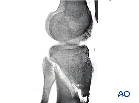 Extraarticular Fracture Metaphyseal Simple