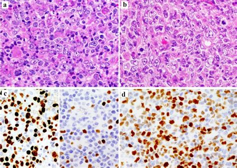 Atypical Lymphocytes Ebv