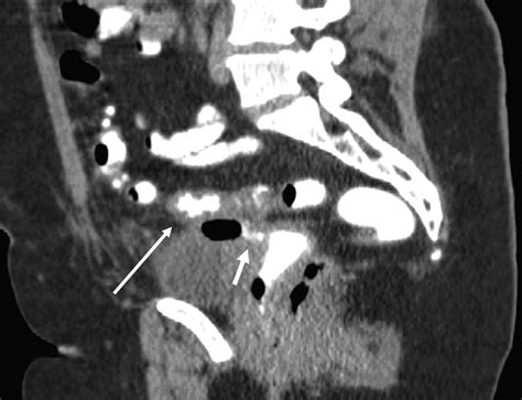 Ct And Clinical Features Of Acute Diverticulitis In An Urban Us