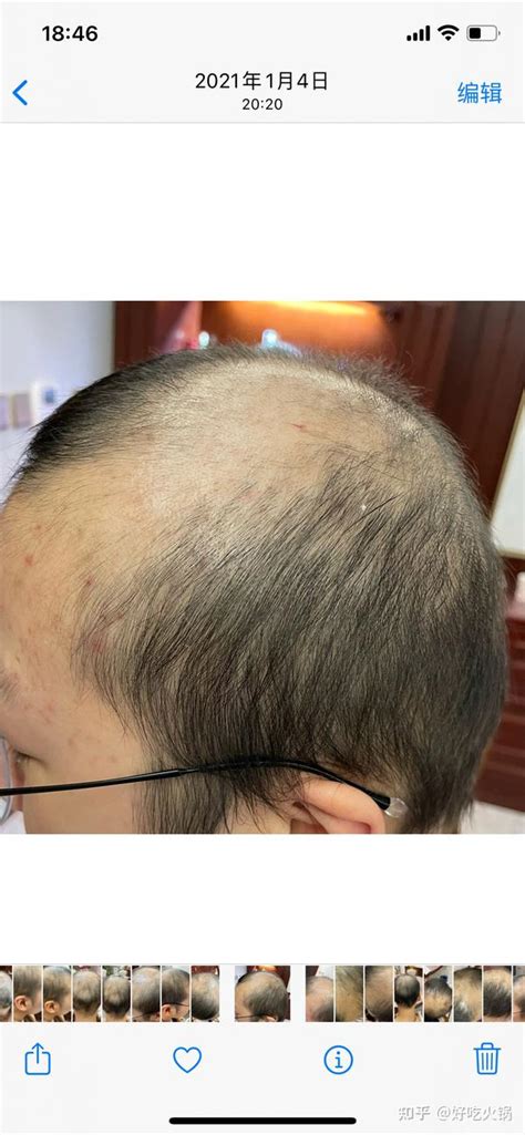Jak抑制剂让我斑秃到普秃到治愈 知乎
