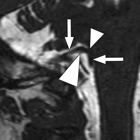 Glossopharyngeal Nerve Mri
